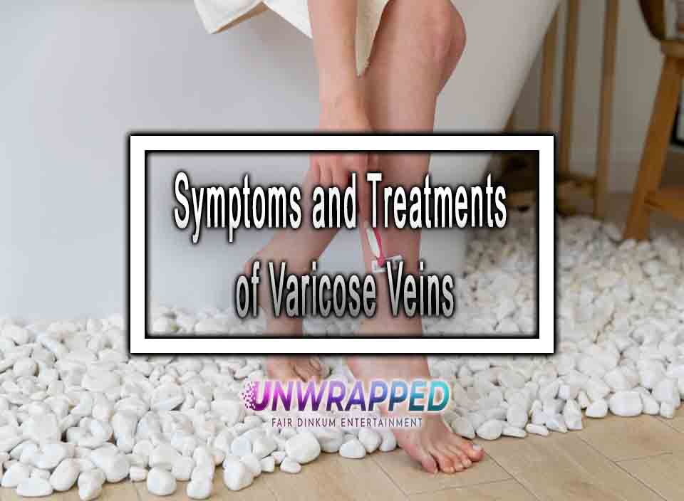 Symptoms and Treatments of Varicose Veins